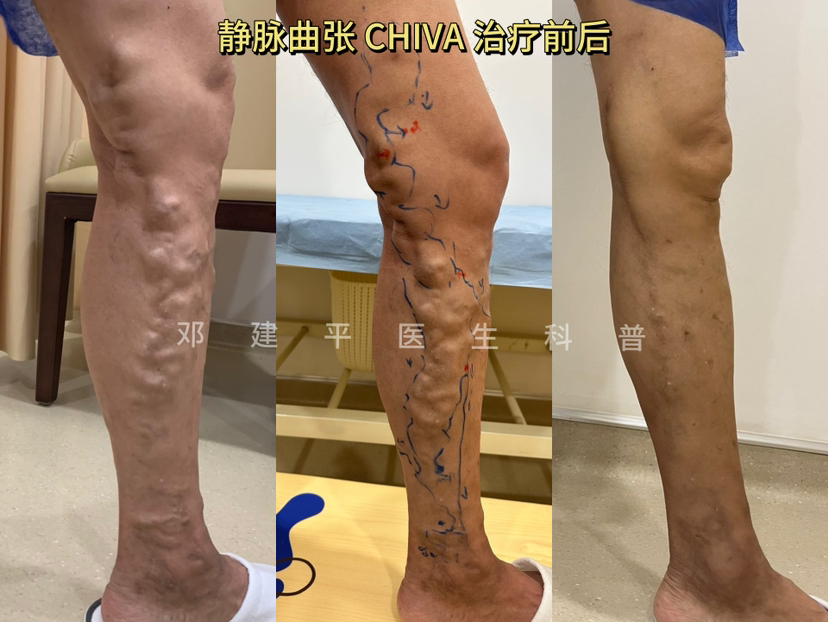 一文了解静脉曲张CHIVA治疗的原理和优缺点