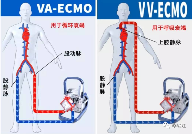 救命神器——“ECMO”，可以借鉴的专家共识有哪些？