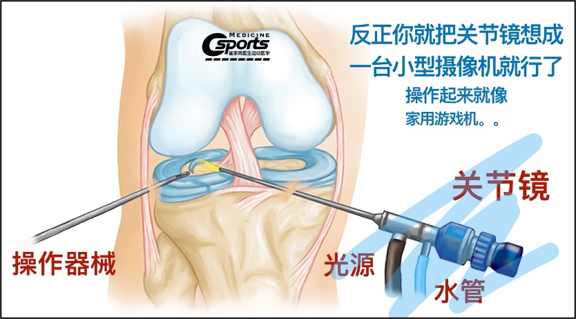 前交叉韧带重建(ACLR)手术前后都发生了什么？-健康160
