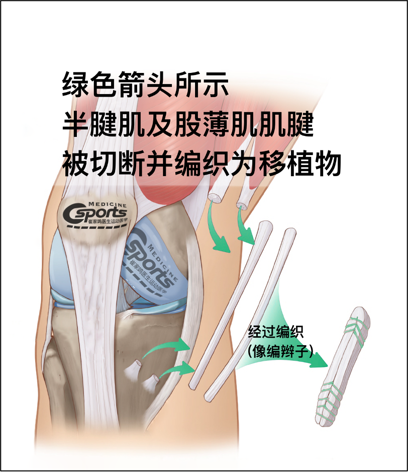 前交叉韧带重建(ACLR)手术前后都发生了什么？-健康160
