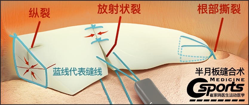 前交叉韧带重建(ACLR)手术前后都发生了什么？-健康160