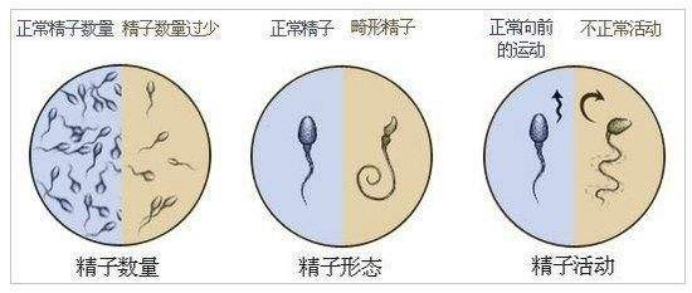 男性不育：“弱精子症”的病因、需完善的检查