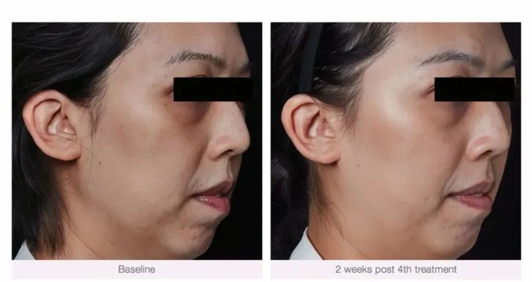 PicoWay | 除了祛斑，超皮秒还能做什么？-健康160