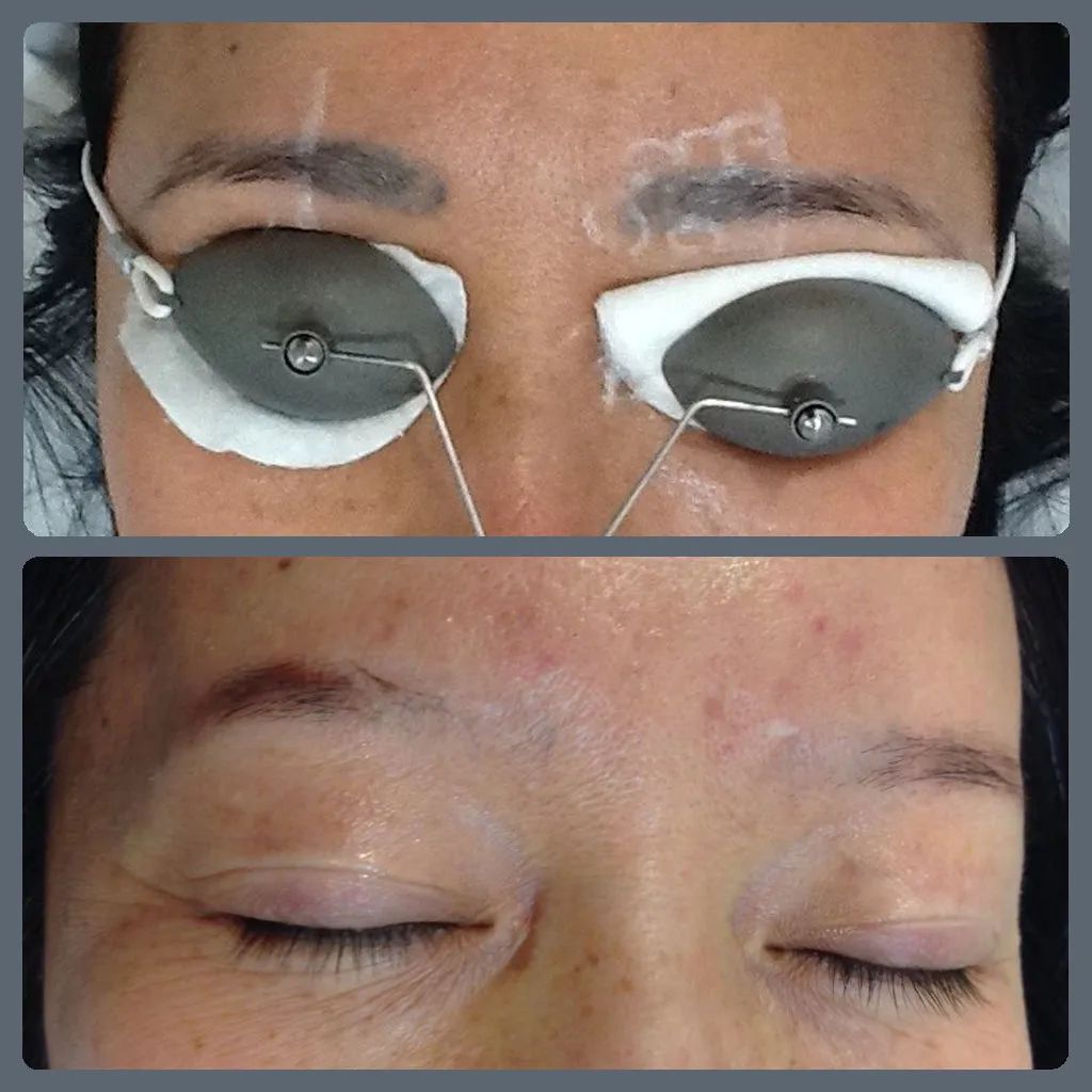 PicoWay | 除了祛斑，超皮秒还能做什么？-健康160