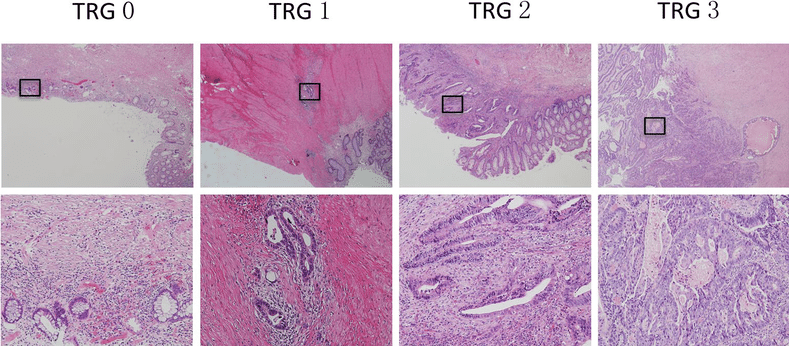 干货-新辅助放化疗后TRG评分方法归纳