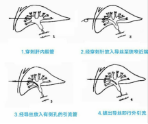 肝胆胰的PTCD管你了解吗？疏通生命之道