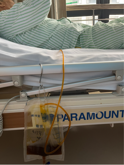 肝胆胰的PTCD管你了解吗？疏通生命之道